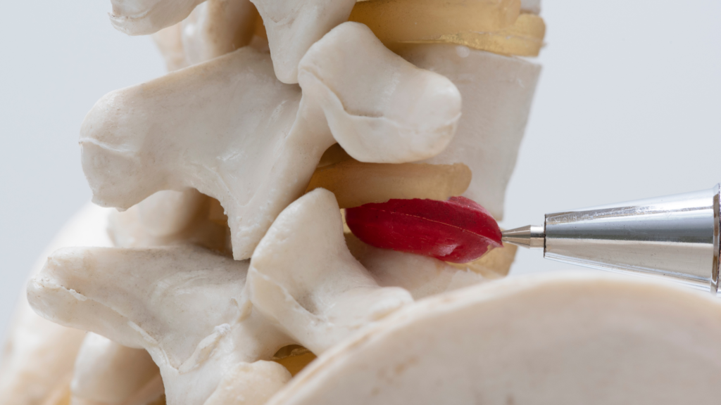 What's the Difference Between Herniated and Bulging Discs - MS Pain ...